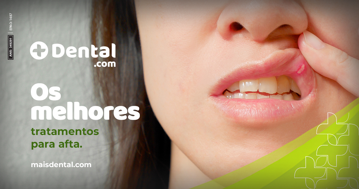 Conheça os melhores tratamentos para a afta | MaisDental